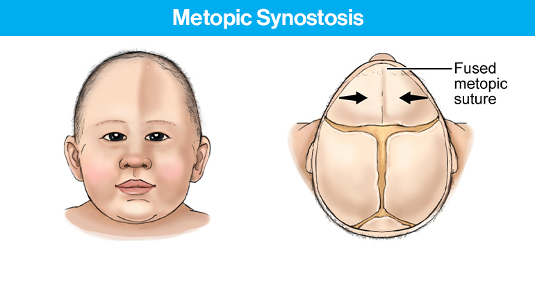 Cranial Disorders and Head Shape | Mount Sinai - New York